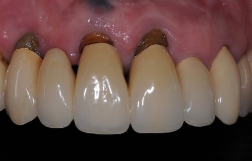 Soft Tissue Management in Implant Dentistry